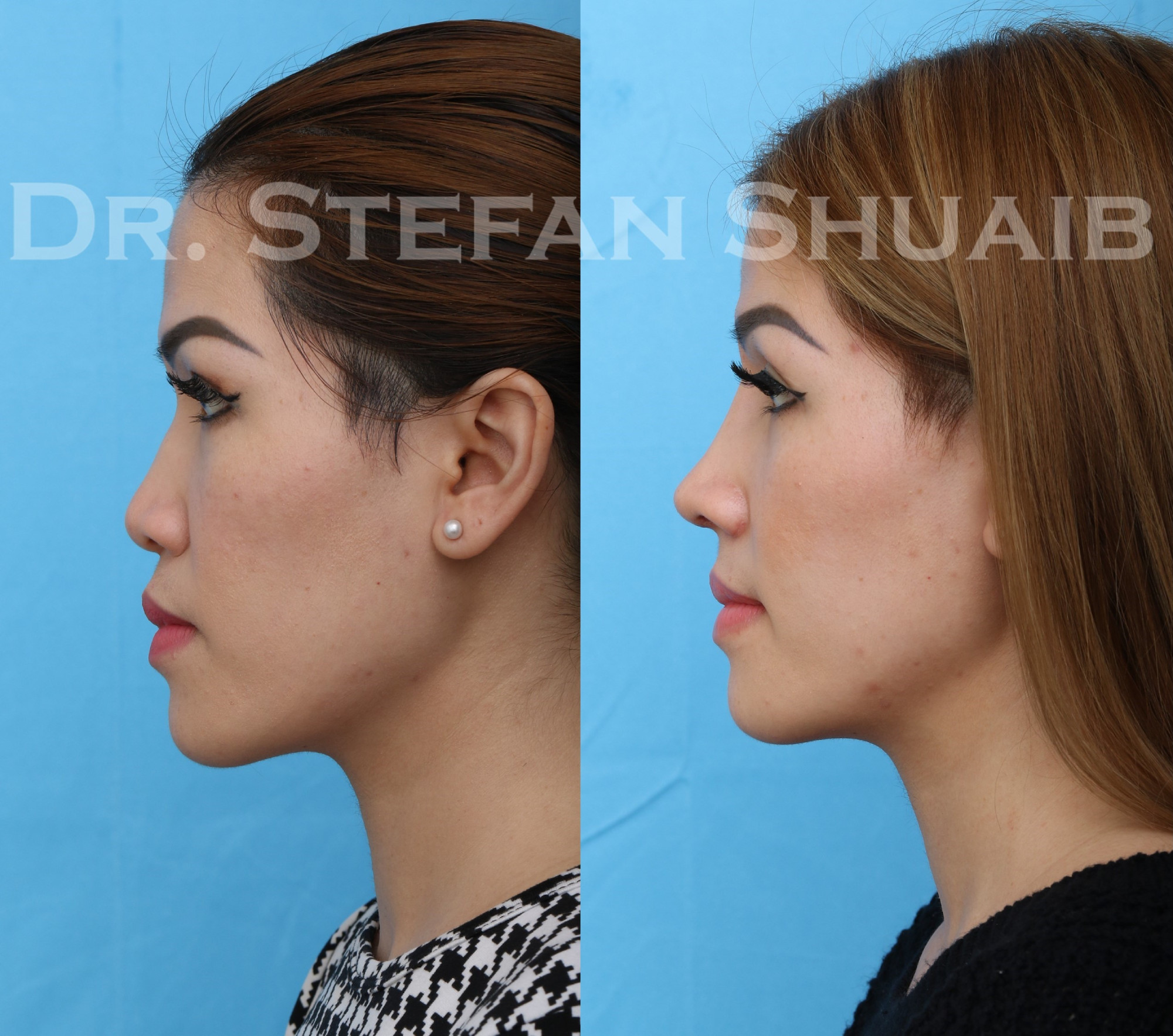 Asian Rhinoplasty Archives | Dallas Facial Plastic Surgery Center