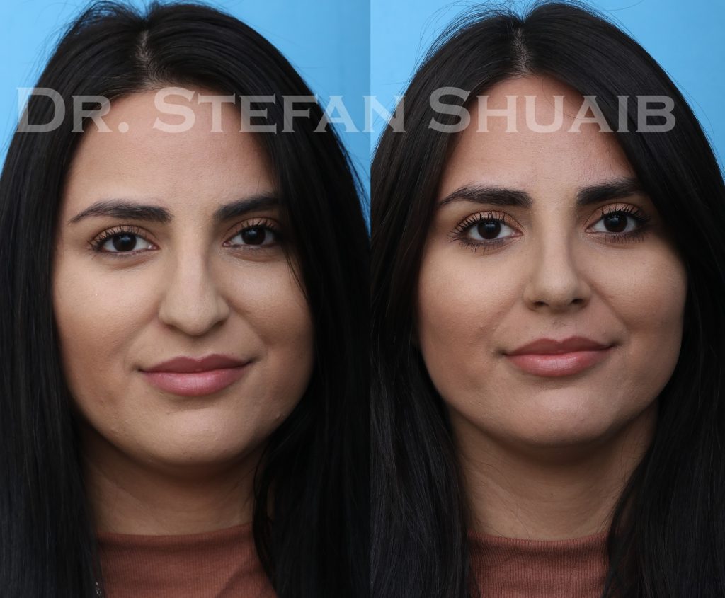 81 | Dallas Facial Plastic Surgery Center
